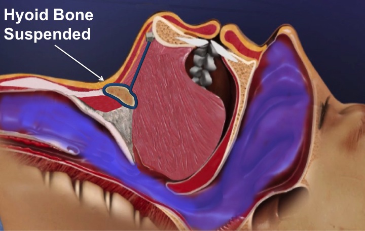 Siesta Medical’s Encore™ System Cleared for Hyoid Suspension in the ...