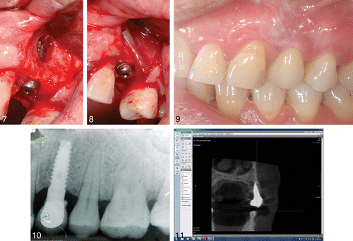 Guided Bone Regeneration Treats Implant Lesions