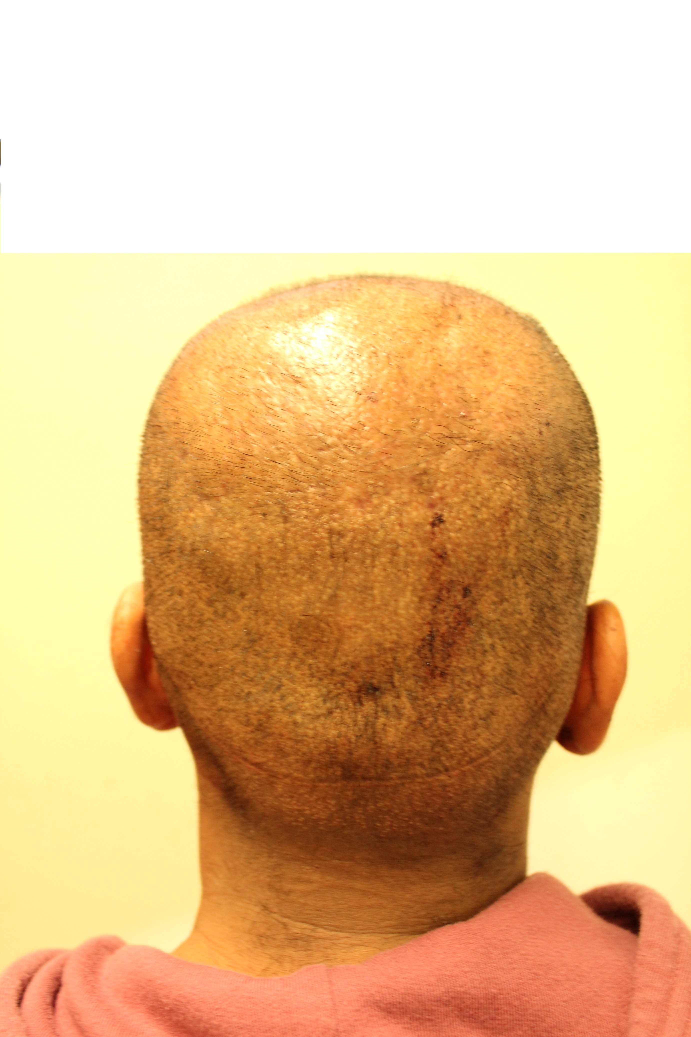 FUE Hair Transplant Donor Area Overharvesting: An Emerging Problem