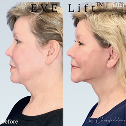 Introducing the EVE Lift™, An Alternative to Traditional Facelifts