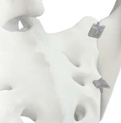 VGI Medical, LLC Announces FDA Clearance of the Novel 3D Printed SiJoin ...